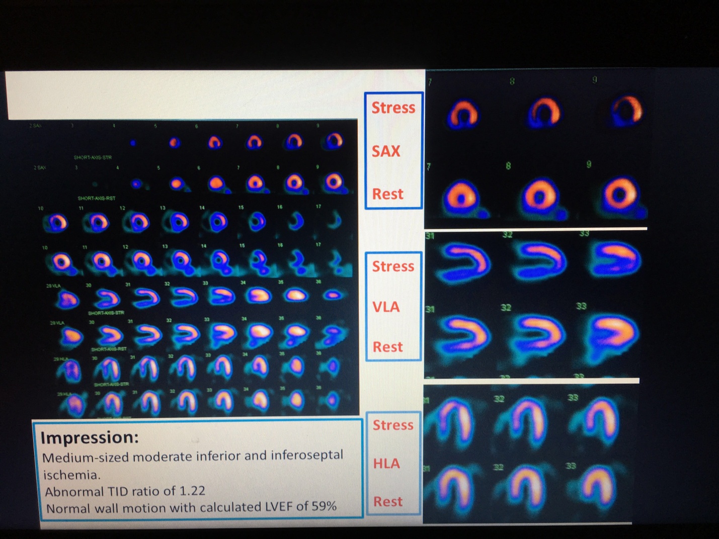 壹生资讯-AAFMUA大查房：急性冠脉综合征（5）