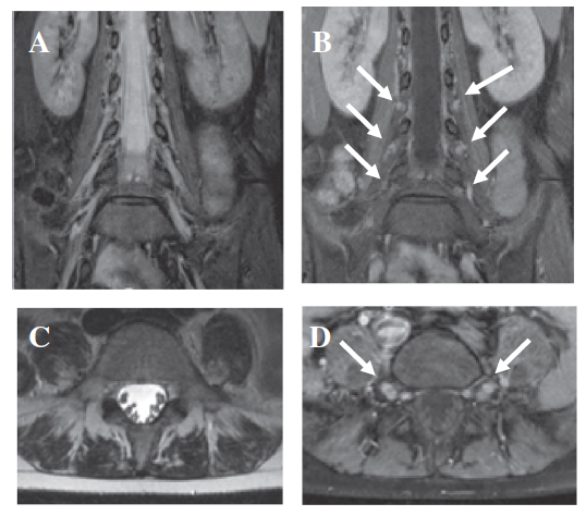 壹生资讯-高分辨率磁共振周围神经成像技术在CIDP患者中的应用