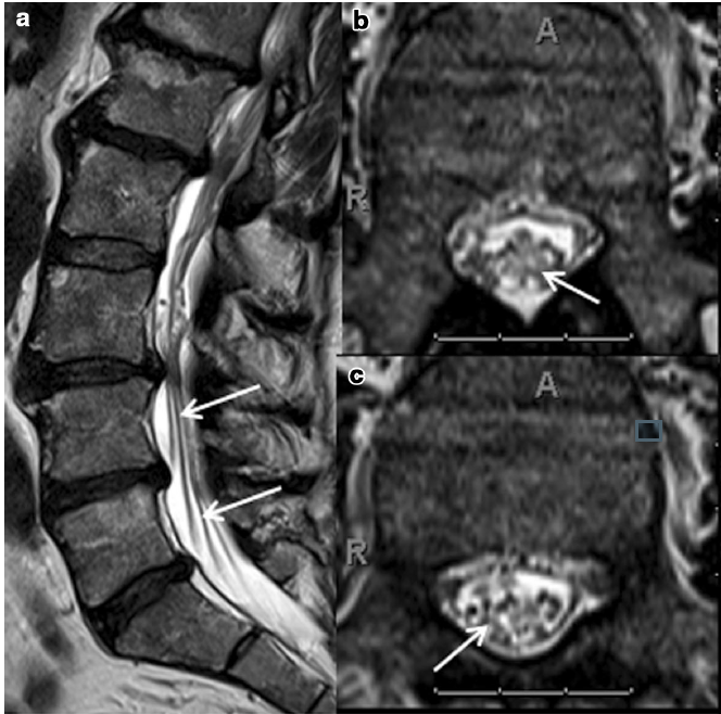 壹生资讯-高分辨率磁共振周围神经成像技术在CIDP患者中的应用