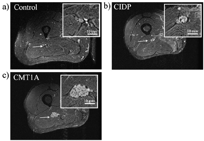 壹生资讯-高分辨率磁共振周围神经成像技术在CIDP患者中的应用
