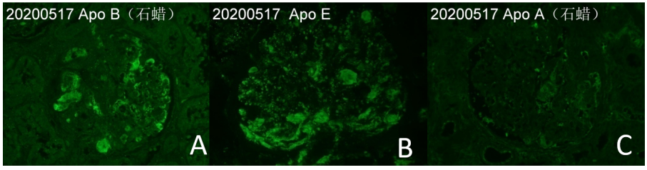壹生资讯-东总病例 | 家族性卵磷脂胆固醇酰基转移酶缺乏症一例